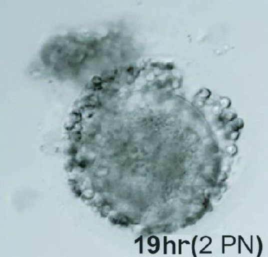 Case report: Eggs with rare perivitelline space defect lead to healthy ...