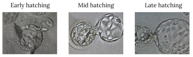 Hatching or hatched blastocysts have improved pregnancy outcomes ...