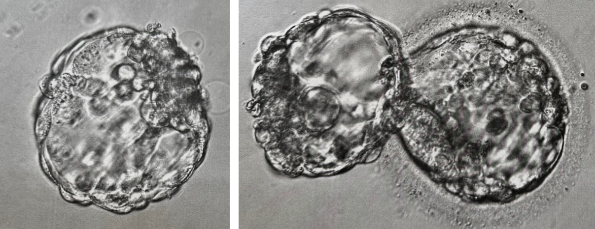 Pregnant at 42 from Day 6 and Day 7 embryos after 7 retrievals | UWOF